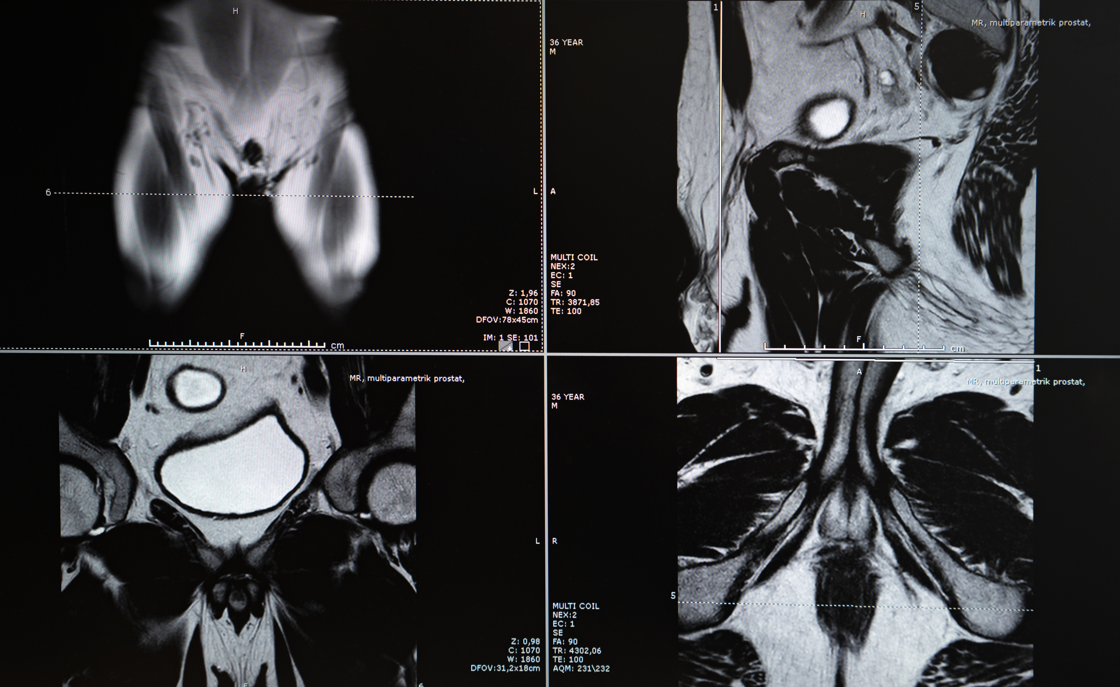 What to know about prostate cancer following Francis Collins’s ...